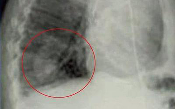 Docs discover pea sprouting in man's lung - Offbeat - Crazy World ...