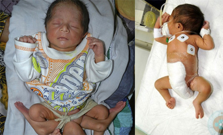 6-legged baby doing well after major surgery - News - Emirates24|7