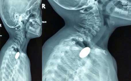 Child saved after swallowing coin - News - Emirates24|7
